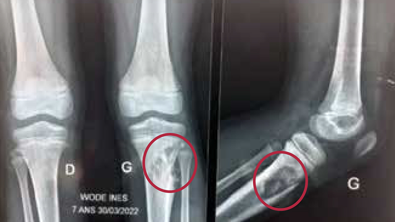 Tuberculose ostéoarticulaire extra rachidienne : aspects diagnostiques ...