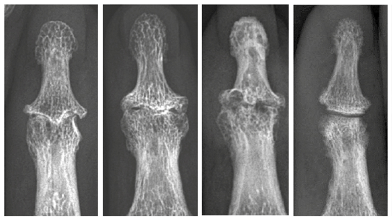 Arthropathies interphalangiennes distales : analyse élémentaire - Le ...