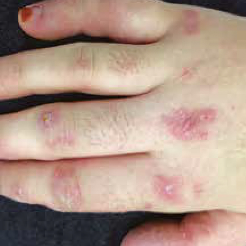 MYOSITES AUTO-IMMUNES - Le Rhumatologue