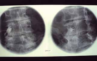 Infiltration Périradiculaire lombaire : une technique sécurisante et ...